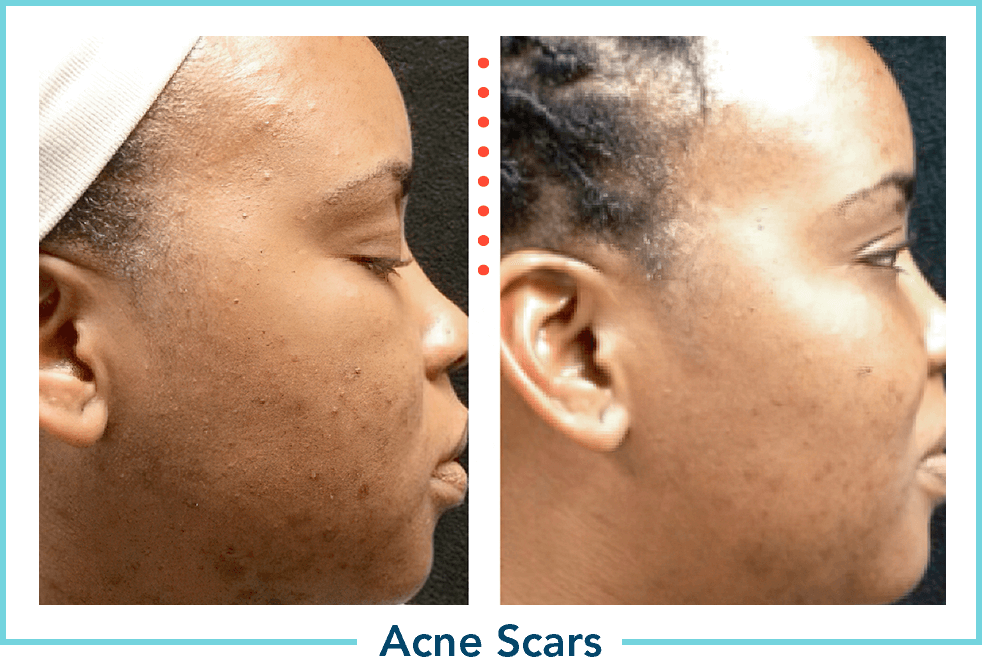 Grow Your Practice With The Cutting-Edge Motorized RF Microneedling