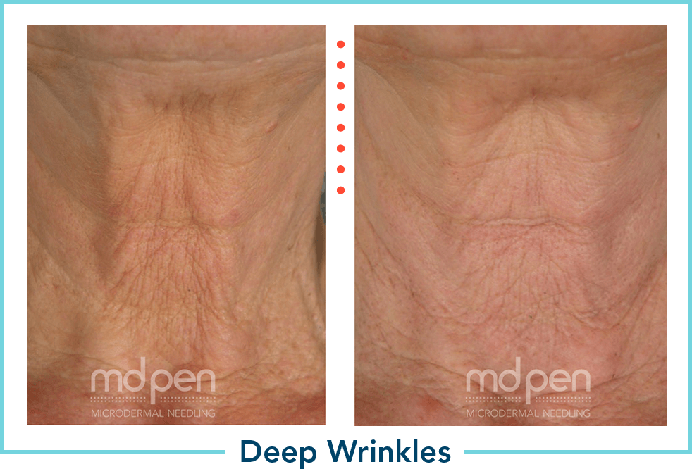 Grow Your Practice With The Cutting-Edge Motorized RF Microneedling