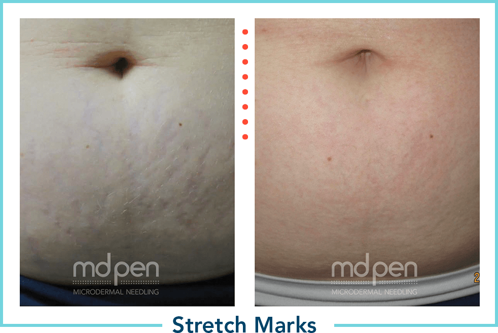 Grow Your Practice With The Cutting-Edge Motorized RF Microneedling